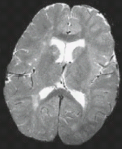 White Matter Diseases and Inherited Metabolic Disorders | Radiology Key