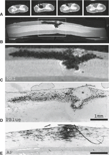 MRI of Spinal Trauma | Radiology Key