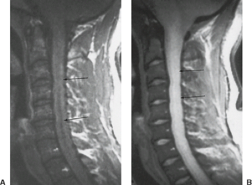 Spinal Infection and Inflammatory Disorders | Radiology Key