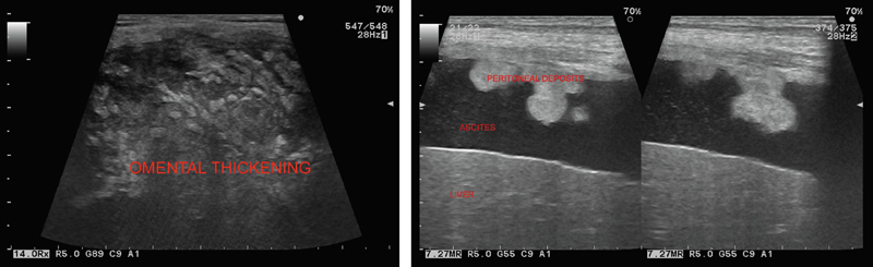 Peritoneum and Retroperitoneum | Radiology Key