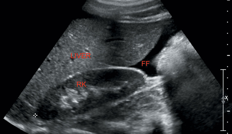 Critical Care Ultrasound—Including FAST (Focused Assessment with ...