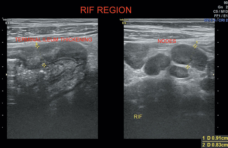 Acute Abdomen and Abdominal Tuberculosis | Radiology Key