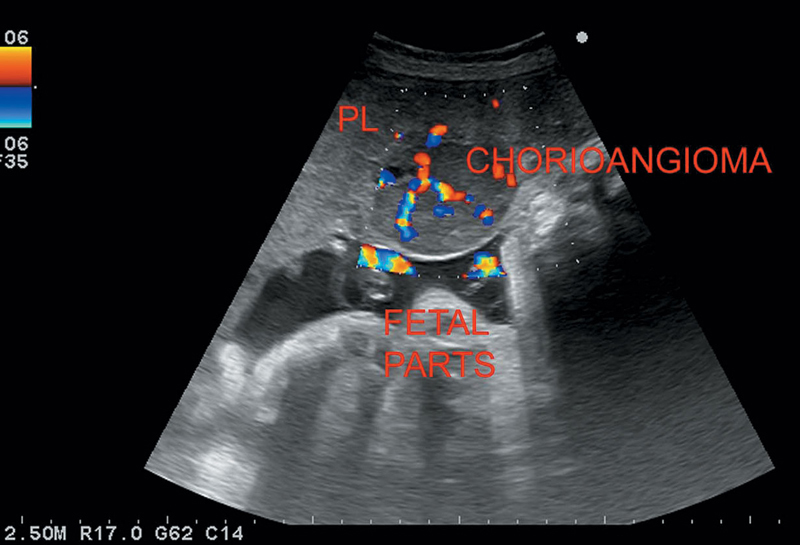 Placenta | Radiology Key