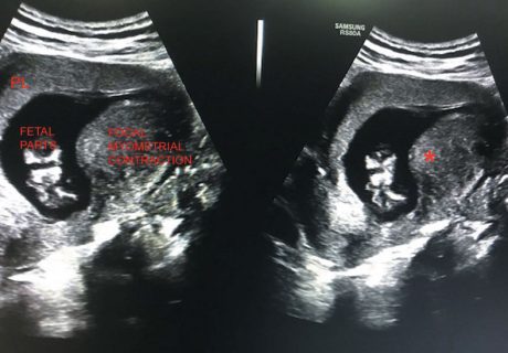 Amniotic Fluid | Radiology Key