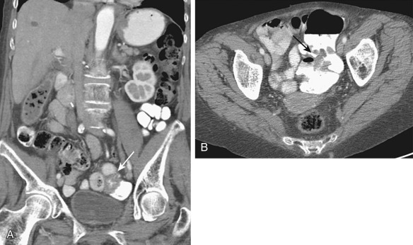 Malignant Neoplasms and Wall Thickening of the Small Bowel | Radiology Key