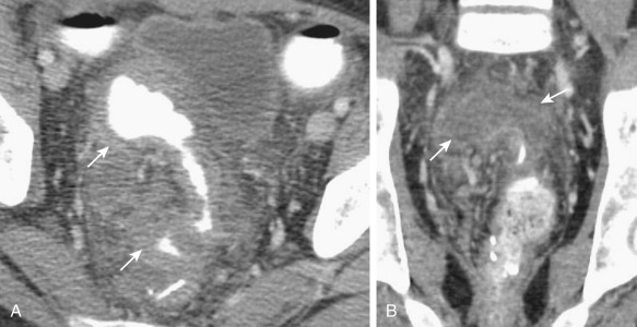 Imaging of the Postoperative Bowel | Radiology Key