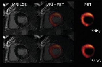Myocardial viability | Radiology Key