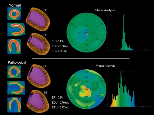 Contractile function and heart failure | Radiology Key