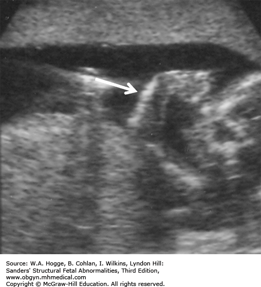 SYNDROMES | Radiology Key