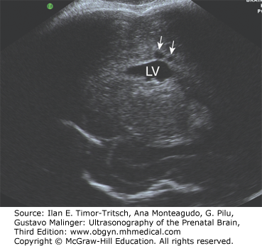 INTRACRANIAL CYSTS | Radiology Key