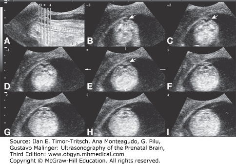 ANOMALIES OF DORSAL INDUCTION | Radiology Key