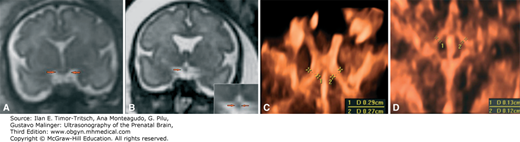 THE FETAL EYE | Radiology Key