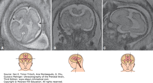 THE FETAL EYE | Radiology Key