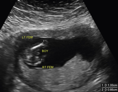 Evaluation of Fetal Anatomy in the First Trimester | Radiology Key