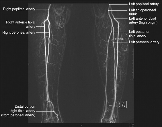 Normal Vessel Anatomy | Radiology Key