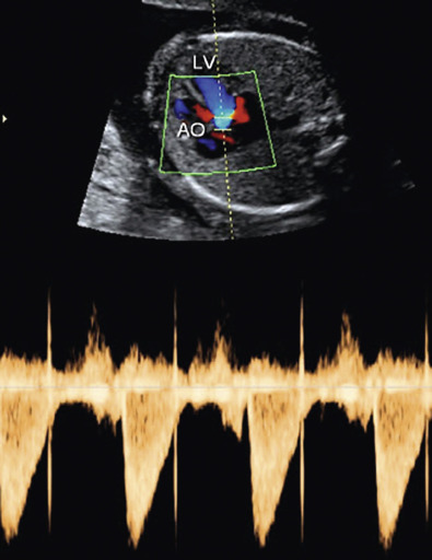 Role of Doppler Sonography in Obstetrics | Radiology Key