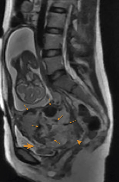 Role of Magnetic Resonance Imaging in Obstetrics | Radiology Key