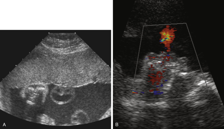 Artifacts, Pitfalls, and Normal Variants | Radiology Key