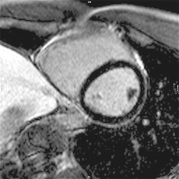 Myocarditis | Radiology Key