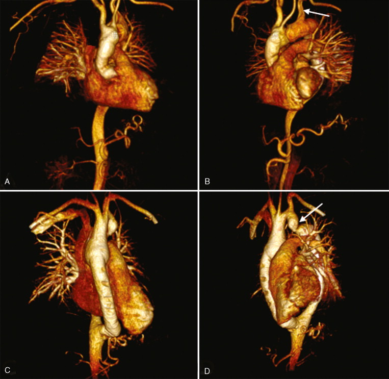 Diseases of the Aorta | Radiology Key