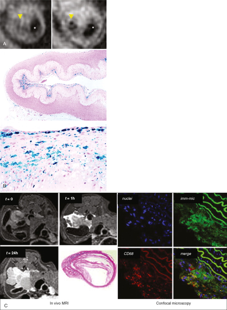Plaque and Wall Assessment | Radiology Key