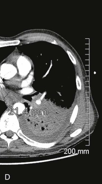 The Silhouette Sign | Radiology Key