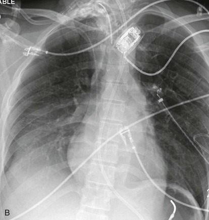 Signs of Lung and Lobar Collapse | Radiology Key