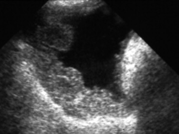 Appendiceal Mucocele | Radiology Key