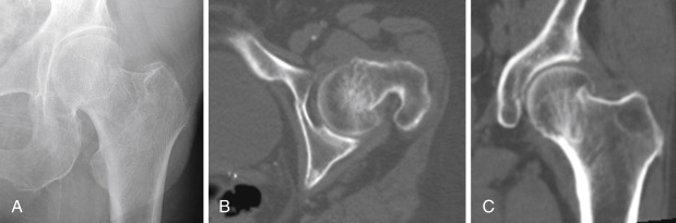 The Hip | Radiology Key