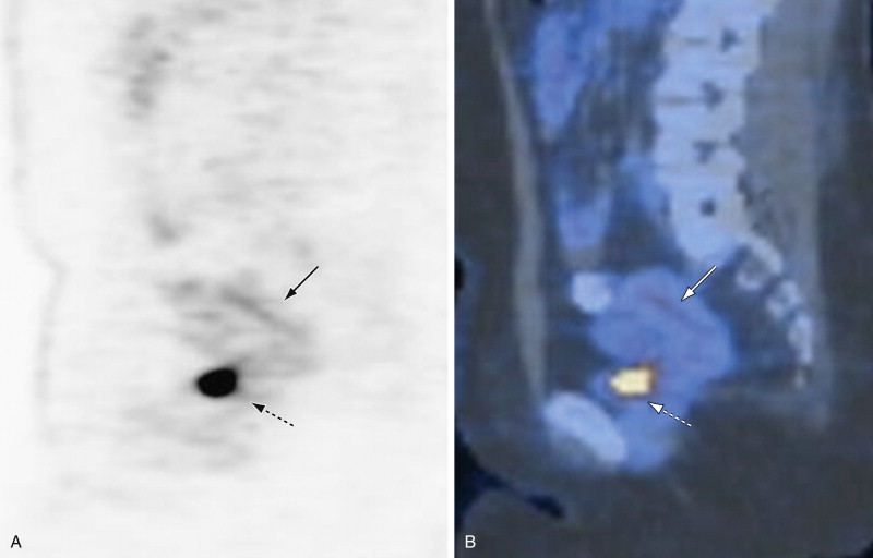 Prometrium For Abnormal Bleeding