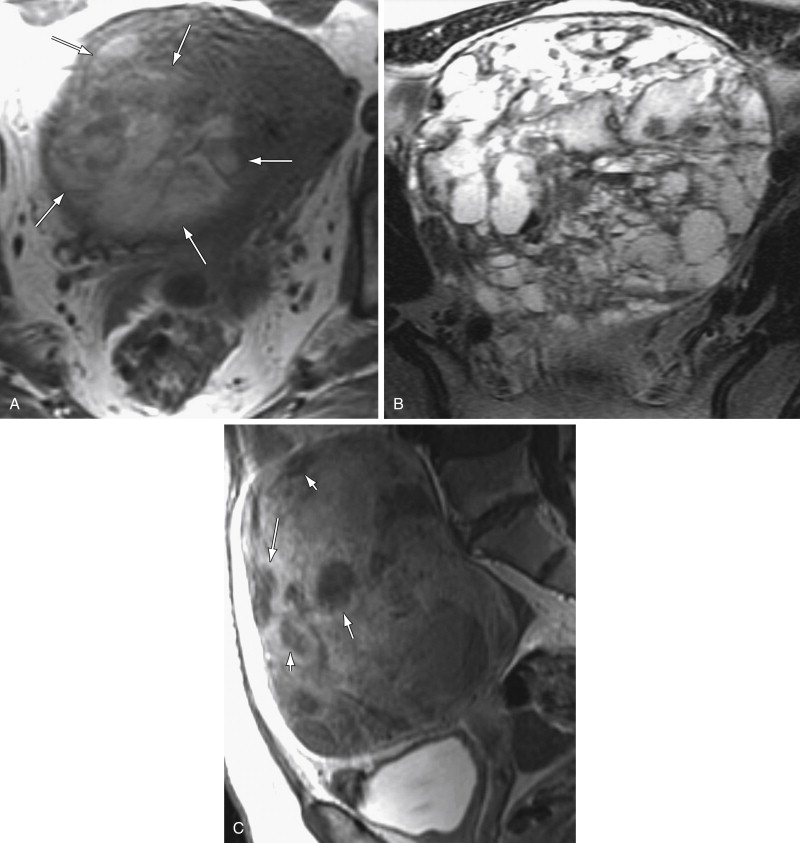 Uterine Leiomyomas | Radiology Key