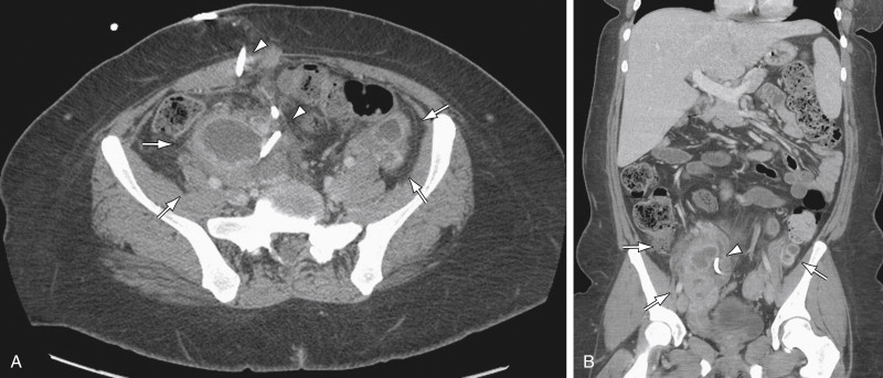 Tubal Abnormalities | Radiology Key