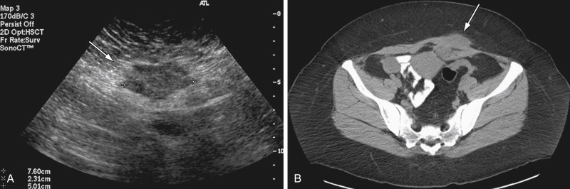 Postpartum Complications Radiology Key