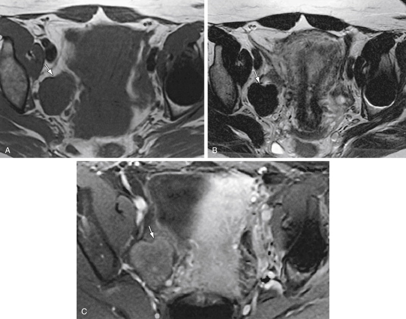 Benign Ovarian Masses | Radiology Key