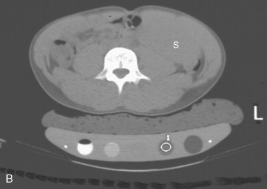 Gaucher’s Disease | Radiology Key