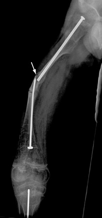Reflex Sympathetic Dystrophy, Migratory Osteoporosis, and Osteogenesis ...