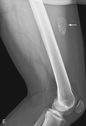 Traumatic Muscle Injuries | Radiology Key