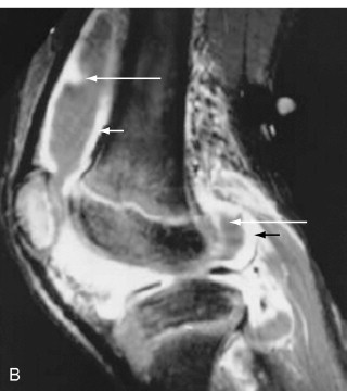 Imaging Investigation of Arthritis in Children | Radiology Key