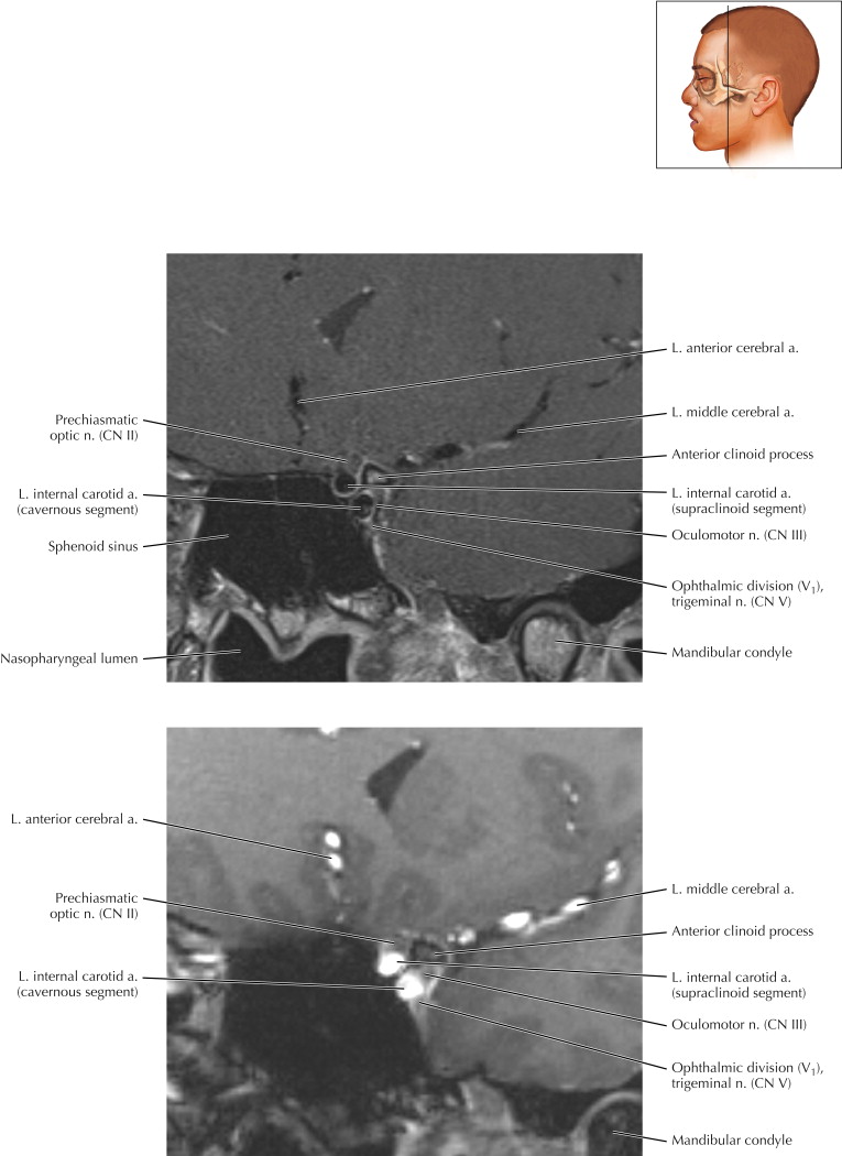 Orbits | Radiology Key