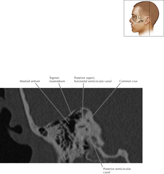 Ventricles and Cerebrospinal Fluid Cisterns | Radiology Key