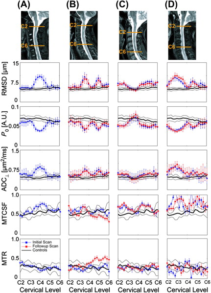 Q-Space Imaging: A Model-Free Approach | Radiology Key