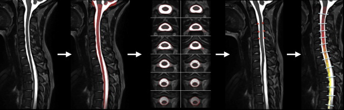 Spinal Cord fMRI | Radiology Key