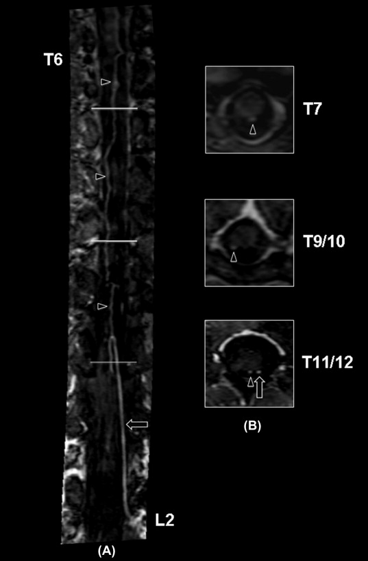 Mapping the Vasculature of the Spinal Cord | Radiology Key
