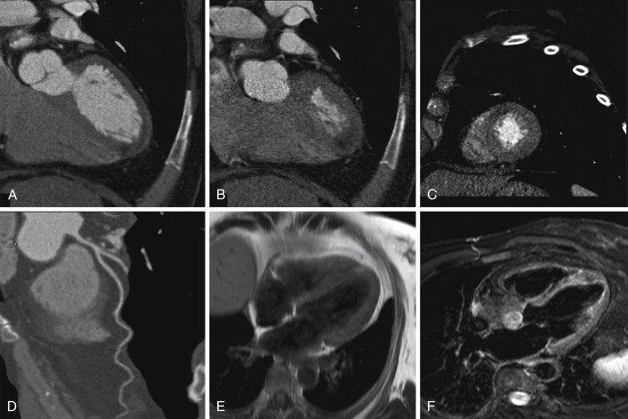 Cardiac and Paracardiac Masses | Radiology Key