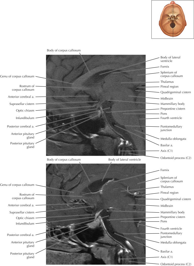 Sella turcica | Radiology Key
