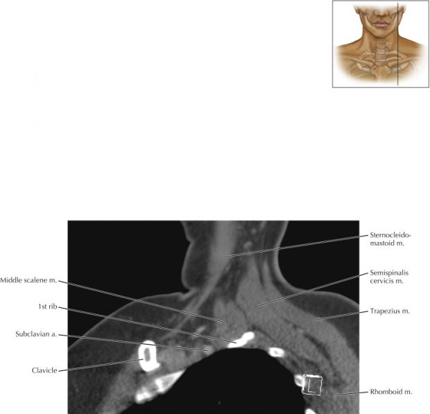 Ventricles and Cerebrospinal Fluid Cisterns | Radiology Key
