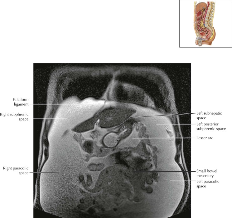 Peritoneal Cavity Radiology Key