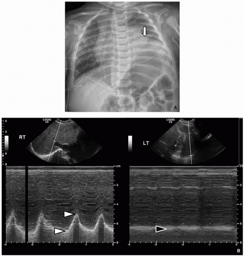 Diaphragm | Radiology Key