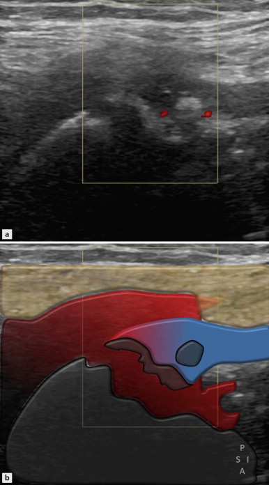 Disorders of the Groin and Hip: Lateral and Posterior | Radiology Key