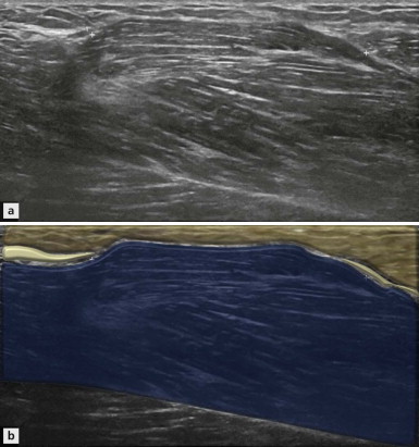 Ultrasound of Muscle Injury | Radiology Key